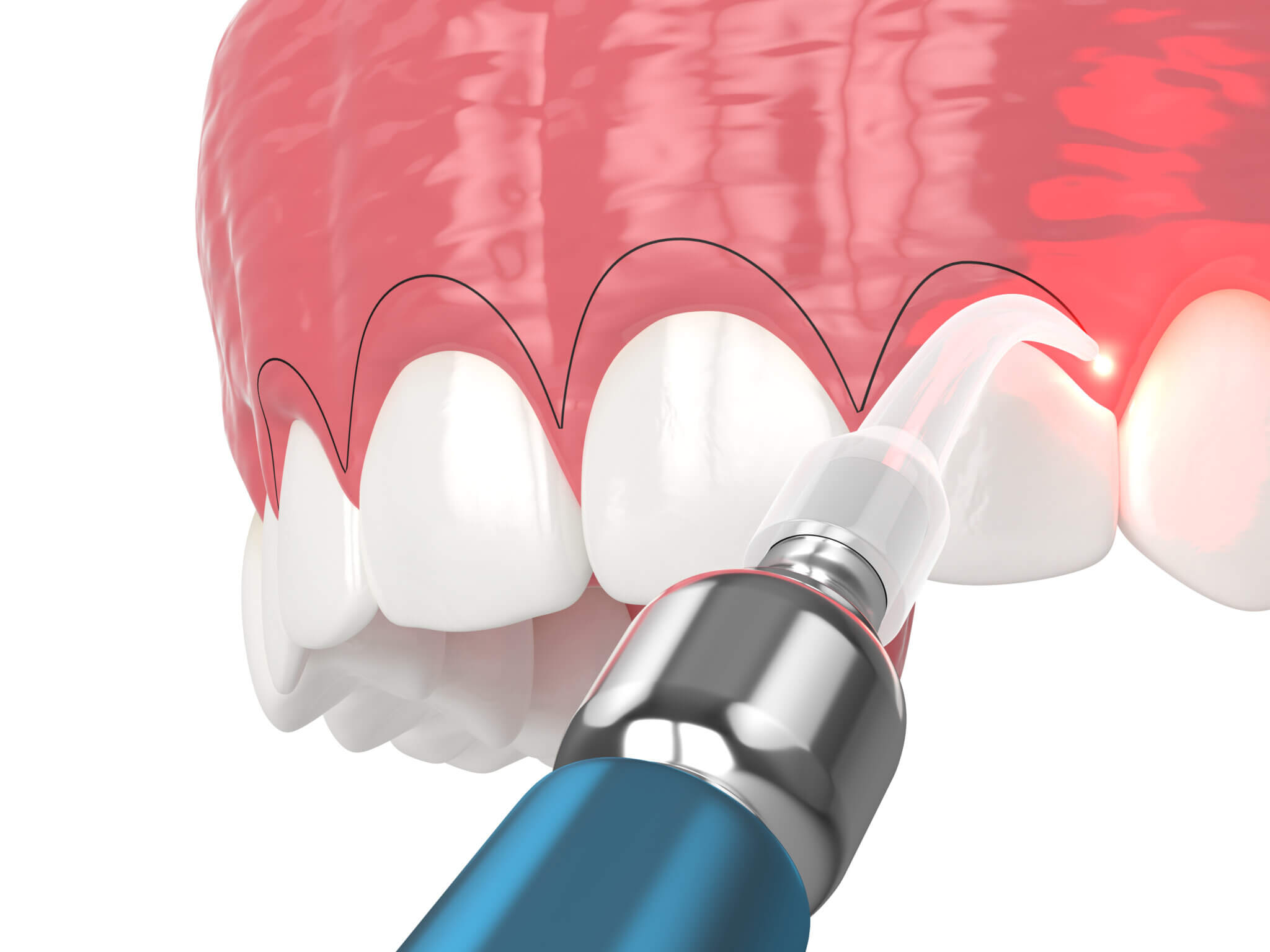 Gum Contouring and Reshaping | Artistic Touch Dentistry